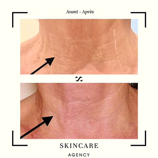 Fils tenseurs - Skincare Agency